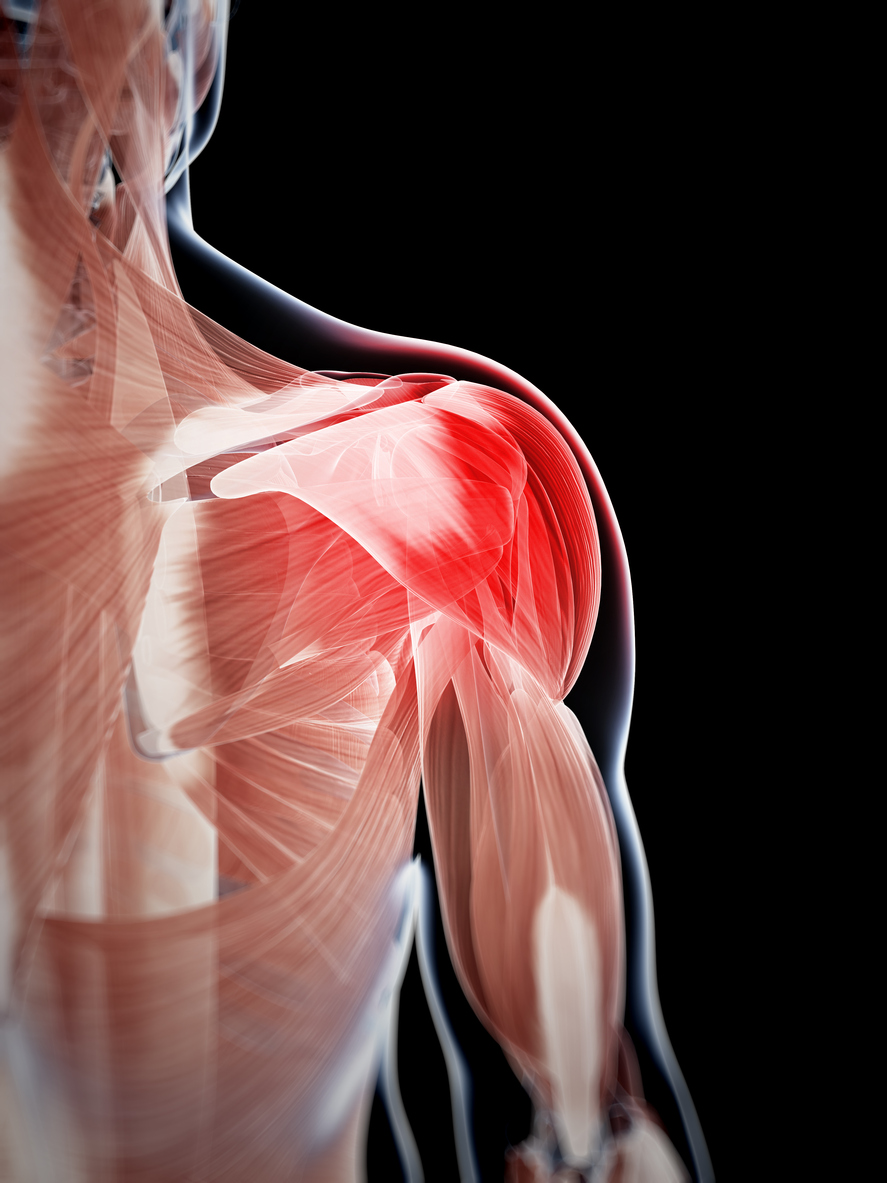 Recognizing the Signs of Tendonitis & How to Treat it
